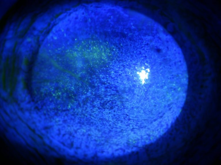 Queratitis – Institut de la Màcula