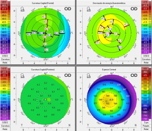Corneal Topography - Institut de la Màcula